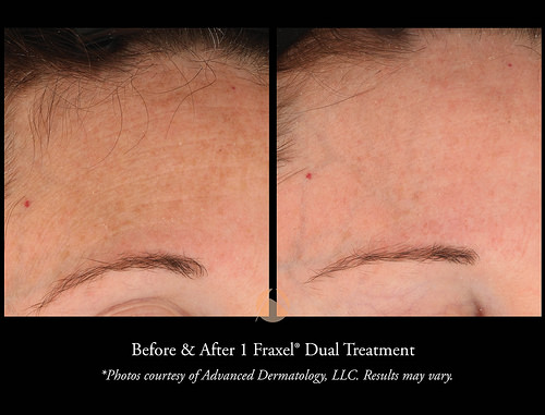 Resurfacing Lasers | Advanced Dermatology
