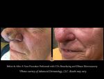 Rhinophyma | Advanced Dermatology