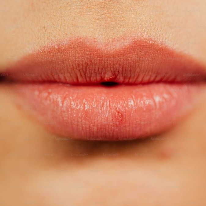 What is a Lip Flip? | Everything About This Botox Cosmetic Procedure